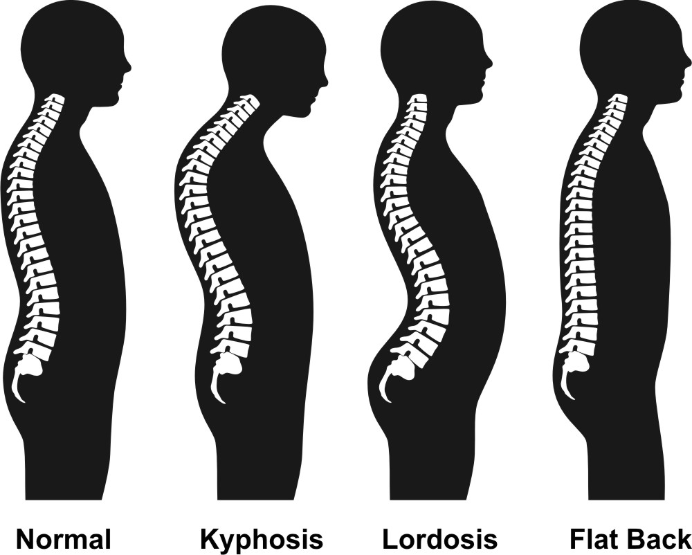 spinal-deformaties - Jane Mackenzie's Pilates Hythe and Folkestone